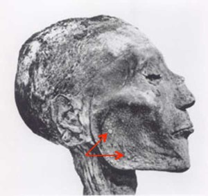 “Smallpox” and “The Devil’s Mark” – Outlander Anatomy