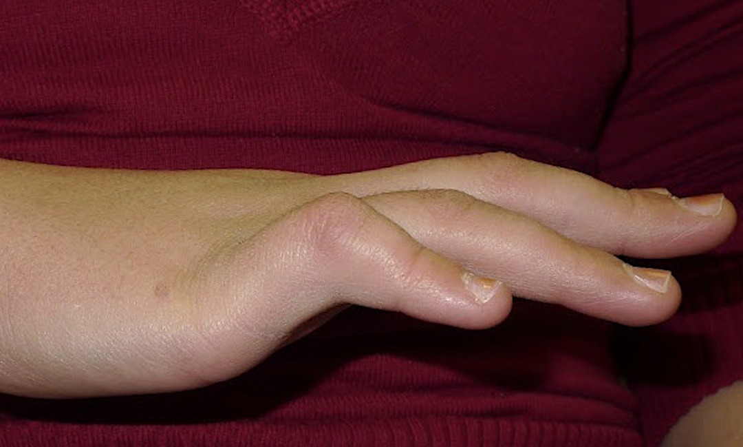 FF: Camptodactyly or Clinodactyly? – Outlander Anatomy
